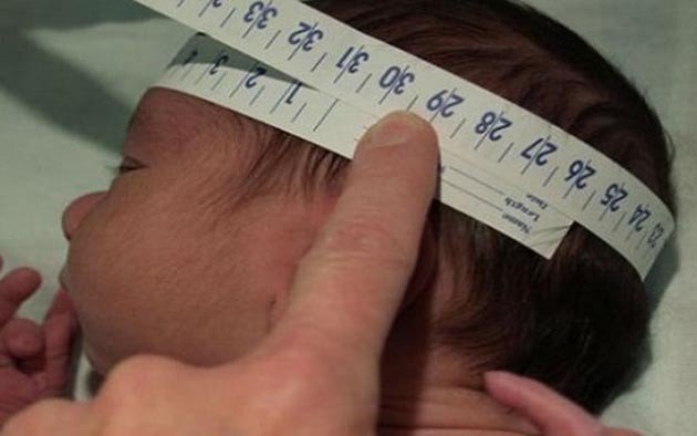 Nace niño dominicano con microcefalia